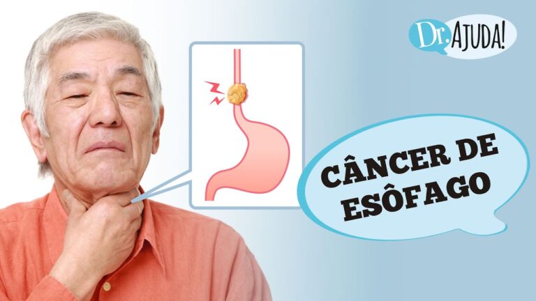 Desafios no diagnóstico e tratamento do cancro do esófago | Actualizado ...