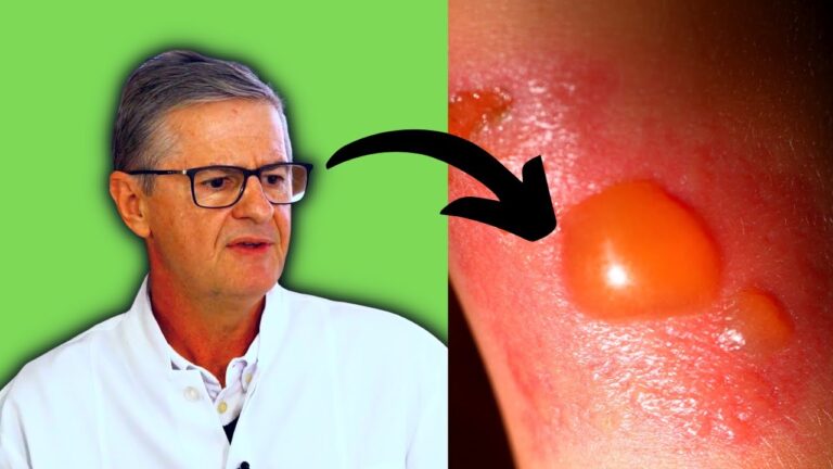 Tratamento Eficaz para Flictenas | Actualizado diciembre 2025