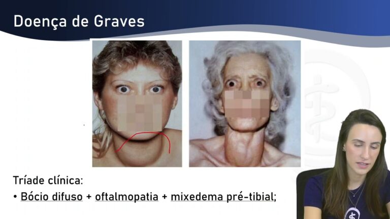 Como Tratar o Mixedema Pré-Tibial: Guia Completo | Actualizado ...