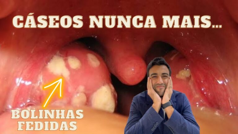 Como Eliminar Caseum Definitivamente: Dicas e Estratégias Eficazes ...