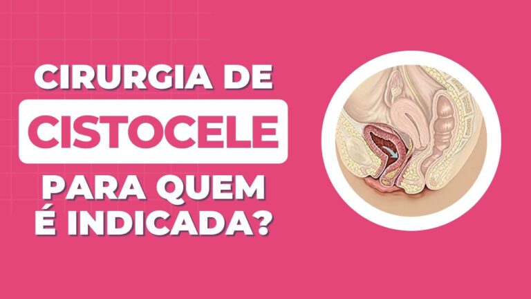 Tratamento Eficaz para Cistocele Grau 2 | Actualizado septiembre 2025