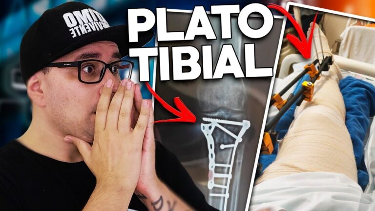 Tempo de Recuperação da Fratura de Perônio | Actualizado diciembre 2025