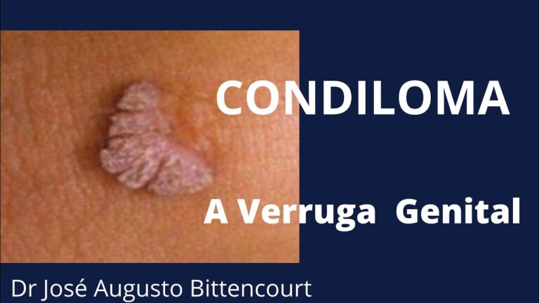 Entendendo a Verruga Genital Masculina: Causas e Tratamentos ...